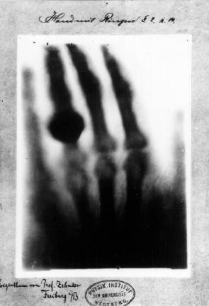 Wilhelm Röntgen and the First X-Ray - Past Medical History